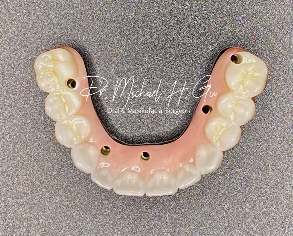 Smart Denture Conversion Quincy MA, South Shore Oral Surgery Associates